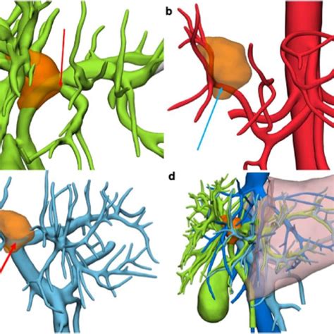 3d Visualization Technology Of A Case Of Peri Hilar Cholangiocarcinoma Download Scientific