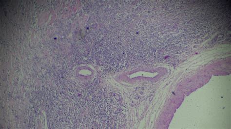 282 Lymph Nodes Cancer Stock Videos Footage And 4k Video Clips Getty