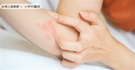 兒童罹異位性皮膚炎，小心長大併氣喘！邱足滿醫師：8撇步減緩異位性皮膚炎不適 華人健康網 專業即時優質的健康新聞及資訊分享平台業即時優質