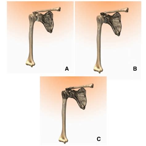 Soft Tissue Sarcoma Abutting The Bone A Is Approached Differently Download Scientific Diagram Soft Tissue Sarcoma Abutting The Bone A Is Approached Differently Download Scientific Diagram