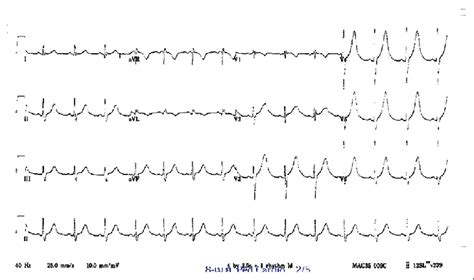 An Electrocardiogram Showed Qtc Prolongation Of 500 Ms Calculated By