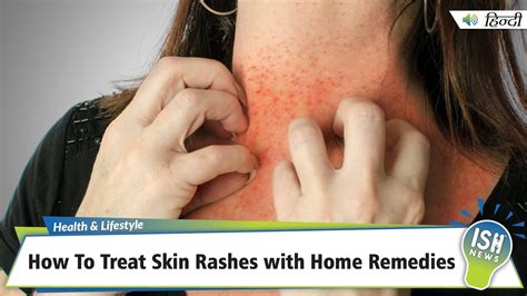 Asthma With Itchy Skin Rash Skin Conditions To Know 40 Off