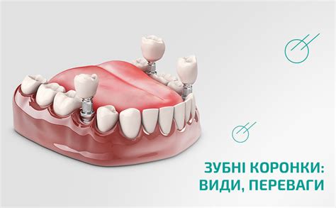 Зубні коронки – види і переваги 🦷 Ціна в Дніпрі ᐉ Amel Dental Clinic
