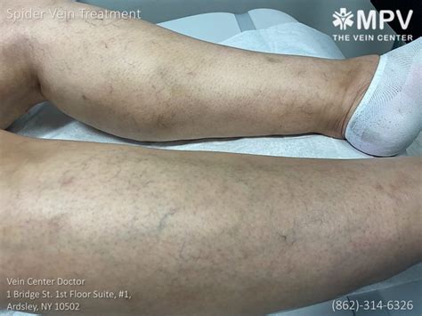 Do Spider Vein Creams Really Work The Truth About Topical Treatments