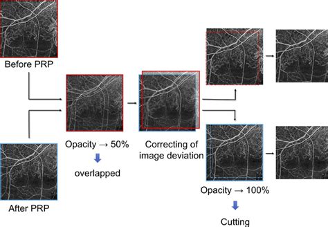 A Proposed Classification Of Intraretinal Microvascular Abnormalities In Diabetic Retinopathy