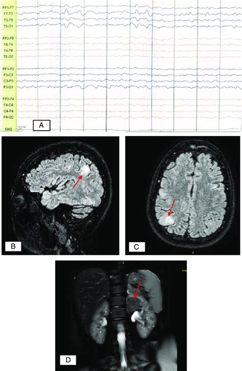 Electroencephalogram Showed Diffuse Epileptiform Abnormalities On The Download Scientific