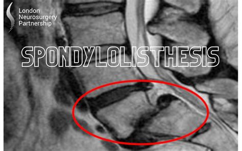 Spondylolisthesis London Neurosurgery Spine