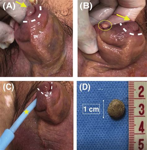 A Photo Demonstrating The Round Partly Ulcerative Lesion Yellow Download Scientific Diagram