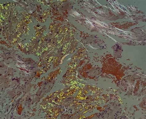 Cardiac Biopsy With Congo Red Stain Demonstrating Apple Green