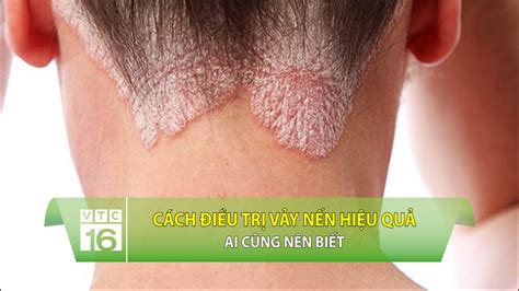 Cách điều Trị Vảy Nến Hiệu Quả Ai Cũng Nên Biết Vtc16 Blog