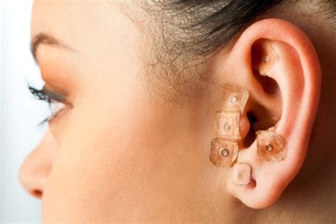 Auriculoterapia o que é para que serve e principais pontos