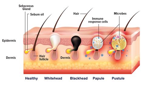 Cjk 2024년 3월호 퍼스널케어 여드름 메커니즘과 발생에서 표준화 블랙씨드오일과 비표준화 블랙씨드오일의 우수성 Kollo