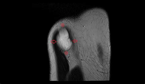 Soft Tissue Sarcoma Mri Radiology Article On Soft Tissue Sarcoma Mri