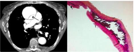 Aortic Dissection And Aneurysm Flashcards Quizlet