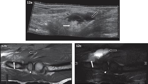 Benign Periarticular Bone And Joint Lipomatous Lesions Smj