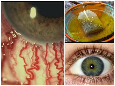 Cómo quitar el ardor en los ojos por soldar 10 remedios caseros y