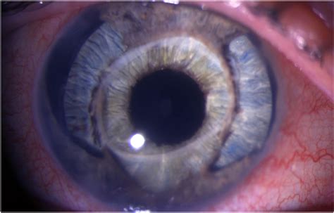 Photograph Showing The Resulting Anterior Segment Following The Procedure Download Scientific