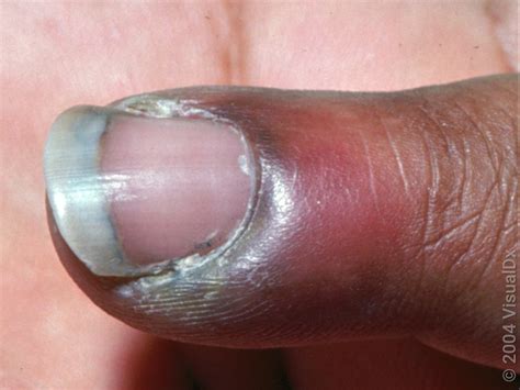 What Does A Nail Bed Infection Look Like Find Out With Pictures Goodrx