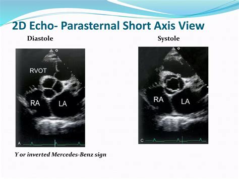 Aortic Stenosis Echocardiography Pptx