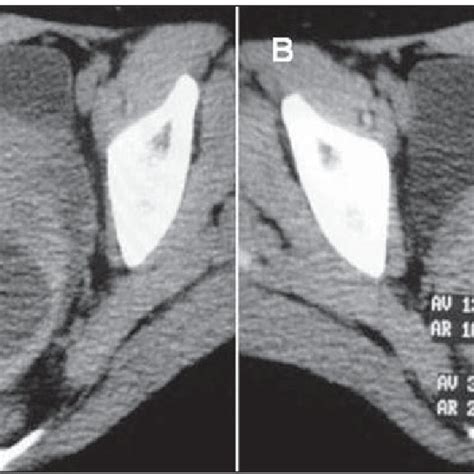 Ovarian Torsion Caused By A Mature Teratoma Pelvic Mri The Left Ovary