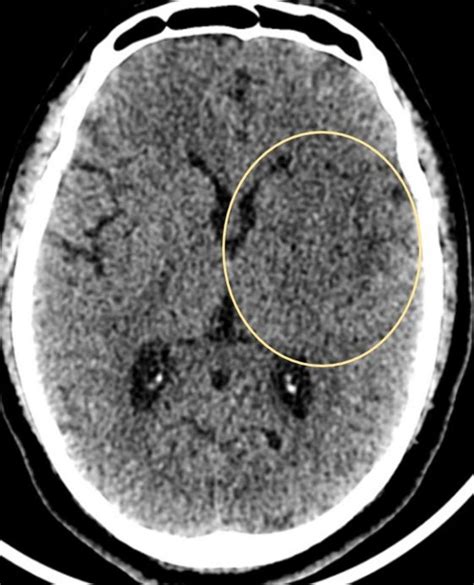 Ct Axial Image Of Brain Demonstrate Loss Of Delineation Of The Left Download Scientific Diagram
