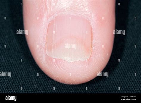 Close Up Of Psoriasis Affecting A Fingernail In A 59 Year Old Female