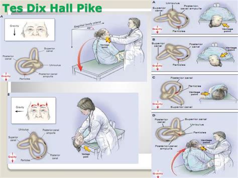 Ppt Benign Paroxysmal Positional Vertigo Bppv Powerpoint