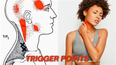 Trigger Points Causes And Symptoms Physio Health And Wellness