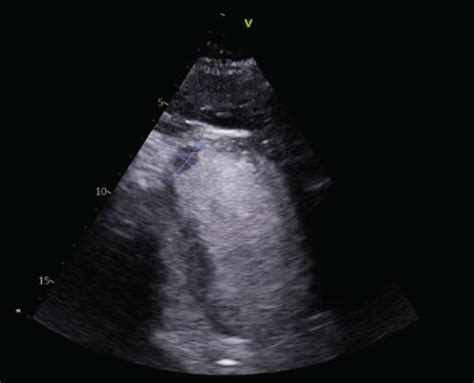 Contrast Enhanced Transthoracic Echocardiogram Contrast Echo