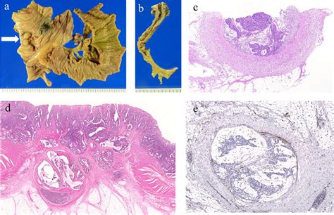Pathological Findings Of The Resected Specimen A Macroscopic Download Scientific Diagram