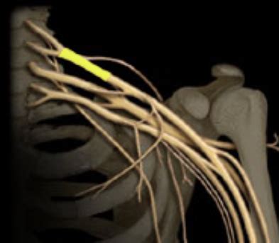 PT691 Brachial Plexus Lecture Flashcards Quizlet