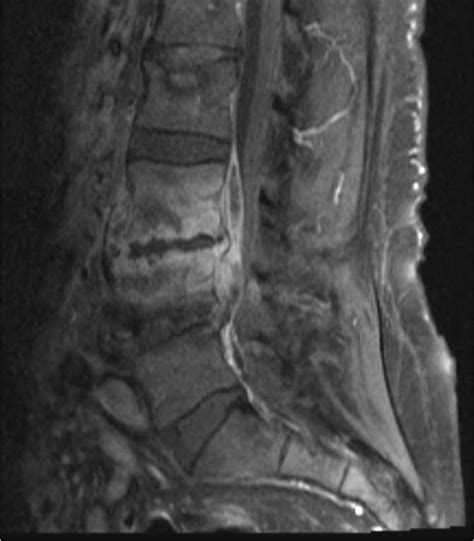 What Is Osteomyelitis Discitis At Marilyn Sylvester Blog