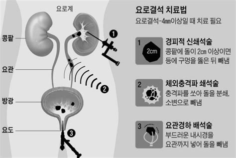 요로결석이란