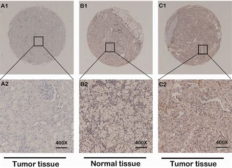 Expression And Clinical Significance Of DOK3 In Renal Clear Cell