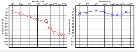 Patient 5 Pure Tone Audiometry Showing A Sensorineural Hearing Loss In