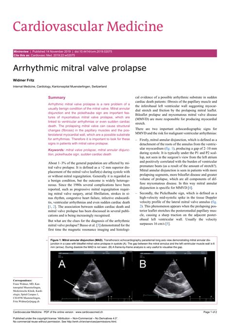 PDF Arrhythmic Mitral Valve Prolapse