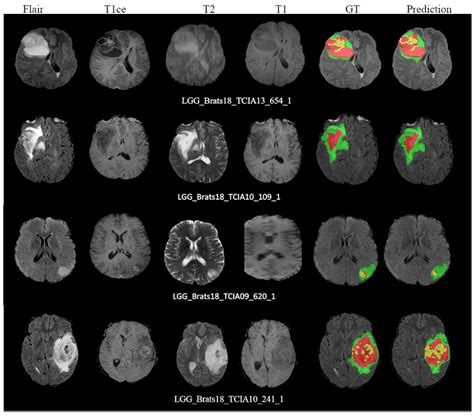 Sample Segmentation Results Of Four Lgg Cases From The Brats2018