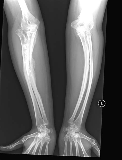 ¿qué Es La Osteogénesis Camde Málaga