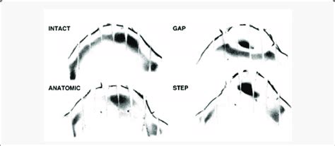 Hip Joint Contact Patterns As Measured By Pressure Sensitive Film