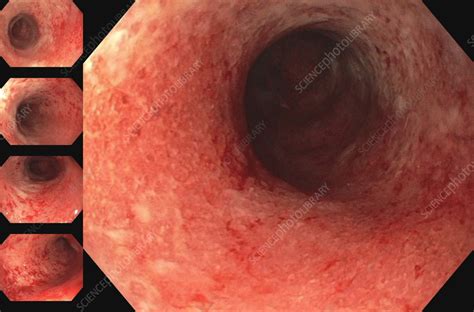Colon In Ulcerative Colitis Endoscope Views Stock Image C0609304 Science Photo Library