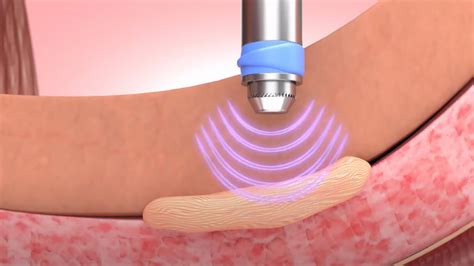 Gainswave Treatment Atlanta Gainswave Therapy In Atlanta Ga Harley