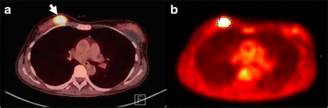 Er Positiveher2 Negative Invasive Ductal Carcinoma In A 45 Year Old
