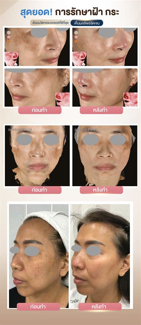 Discover Pico เทคโนโลยีรักษาหลุมสิวใหม่ล่าสุด รักษาทุกผิว Blclinicthailand