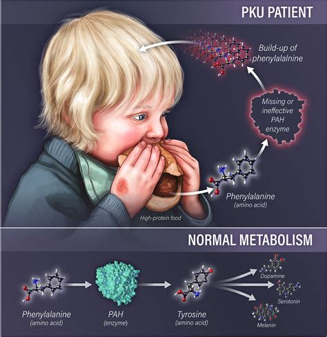 Phenylketonuria Patient