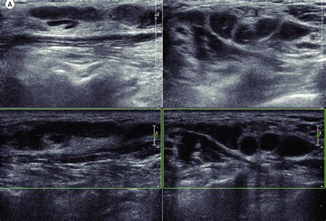 A 53 Year Old Female Patient With Cervical Sparganosis A Grayscale