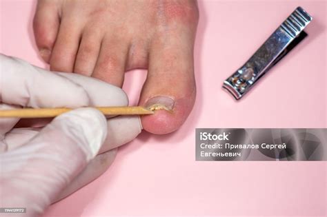 분홍색 배경에 고립 된 손 발톱 장갑에 있는 닥터의 손은 못에 손상을 검사 합니다 손톱 판에 기계적 손상 쉘 락 또는 젤 바니시 를 바른 후 손톱 손상 건강관리와 의술에