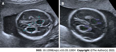 Isolated Choroid Plexus Cysts 25 Year Old Second Pregnancy 20 Wk Of