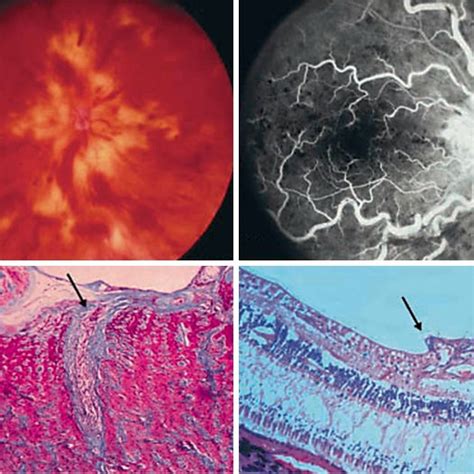 PDF Retinal Anatomy And Pathology