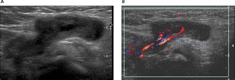 Sonography Of Various Cystic Masses Of The Female Groin Oh 2007