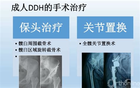 钱文伟：全面解析成人发育性髋关节脱位（ddh）分型 骨科在线